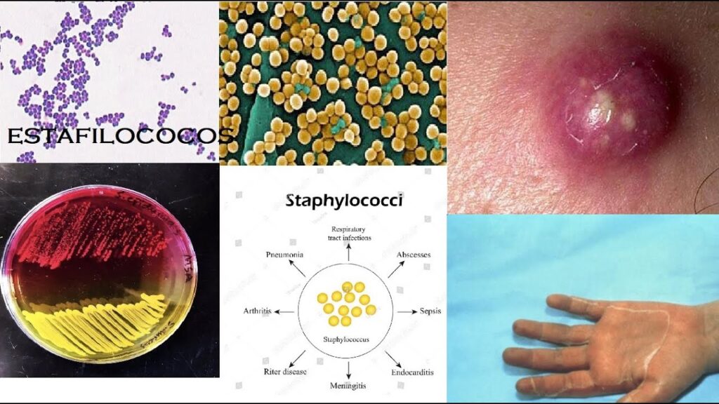 Diferencia entre estafilococo y estafilococo dorado - PEDIAEXPERTOS