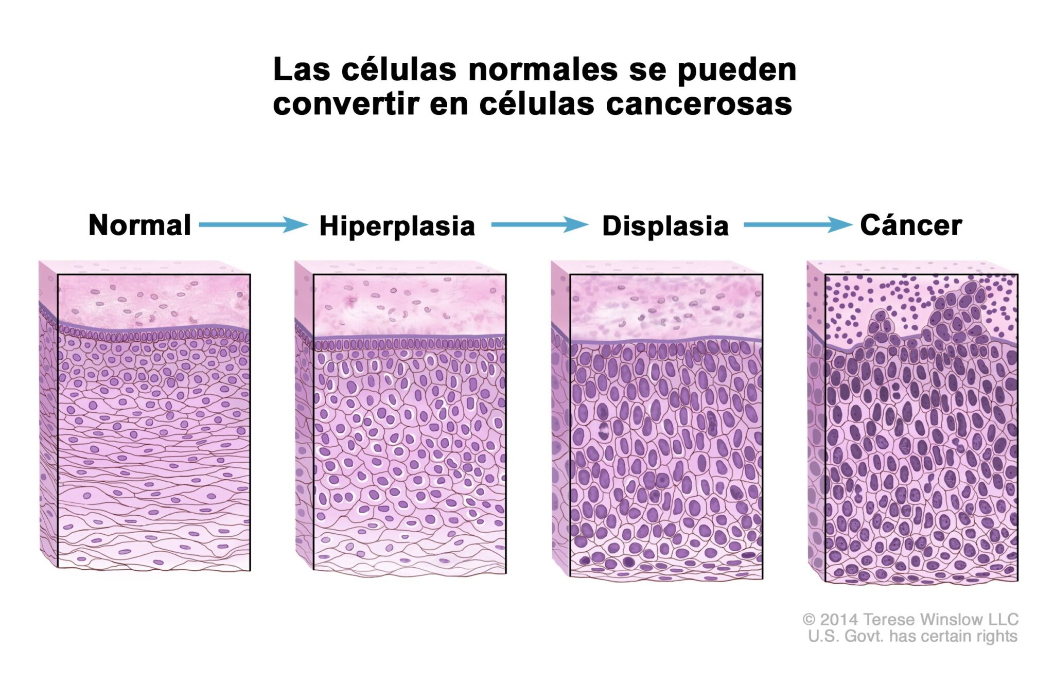 Diferencia entre metaplasia y displasia - PEDIAEXPERTOS