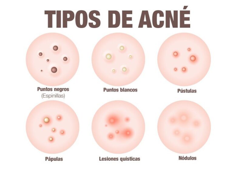 Diferencia entre grano y espinilla - PEDIAEXPERTOS
