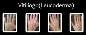 Diferencia entre vitíligo y leucodermia - PEDIAEXPERTOS